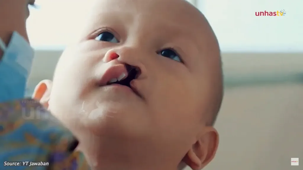 Penanganan Bibir Sumbing pada Anak, Dokter Tajrin: Dimulai Sejak Lahir ...